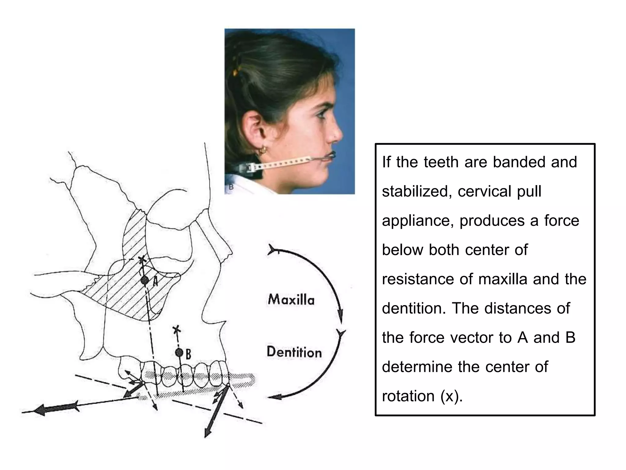 Biomechanics of Headgears | PPTX