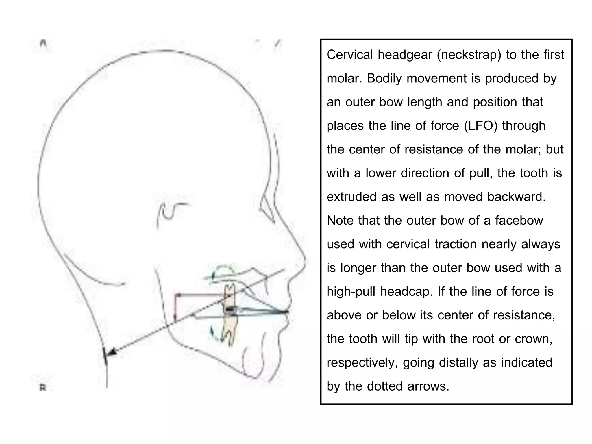Biomechanics of Headgears | PPTX
