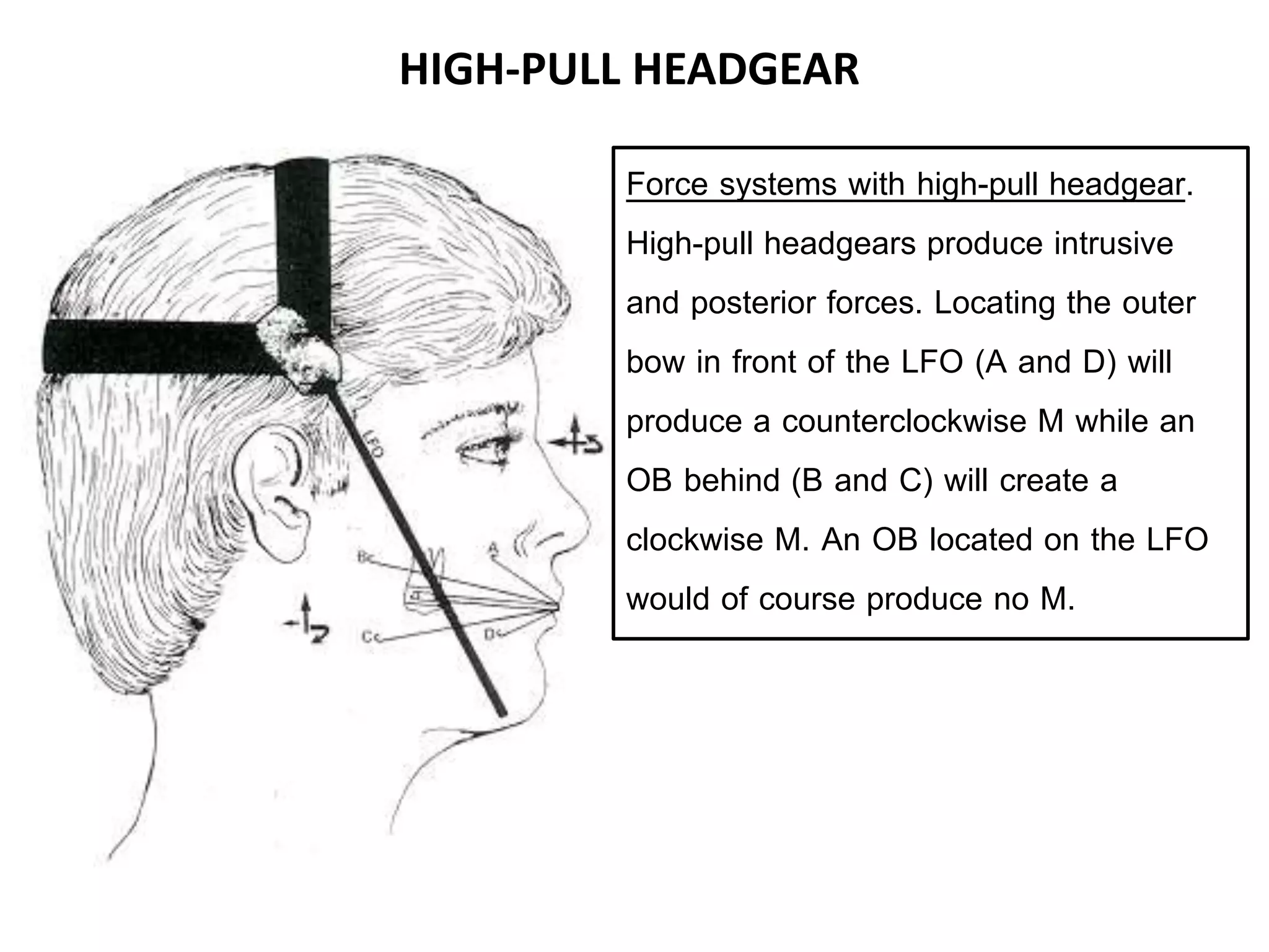Biomechanics of Headgears | PPTX | Dental Health | Diseases and Conditions