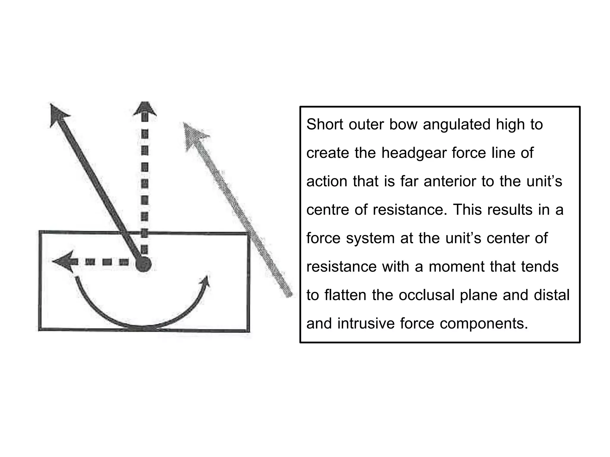 Biomechanics of Headgears | PPTX