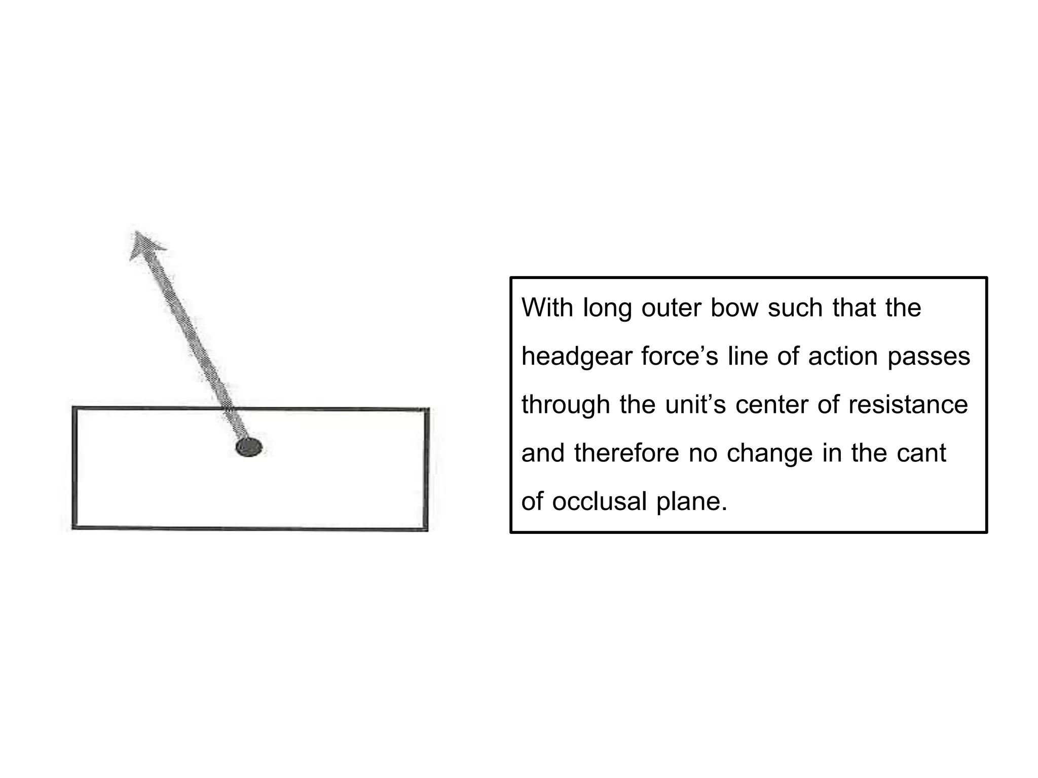 Biomechanics of Headgears | PPTX