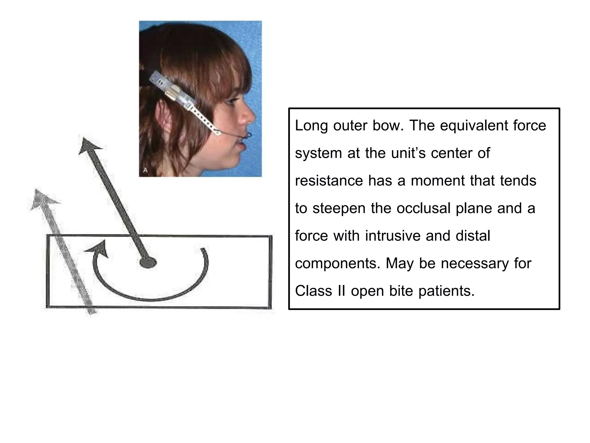 Biomechanics of Headgears | PPTX | Dental Health | Diseases and Conditions
