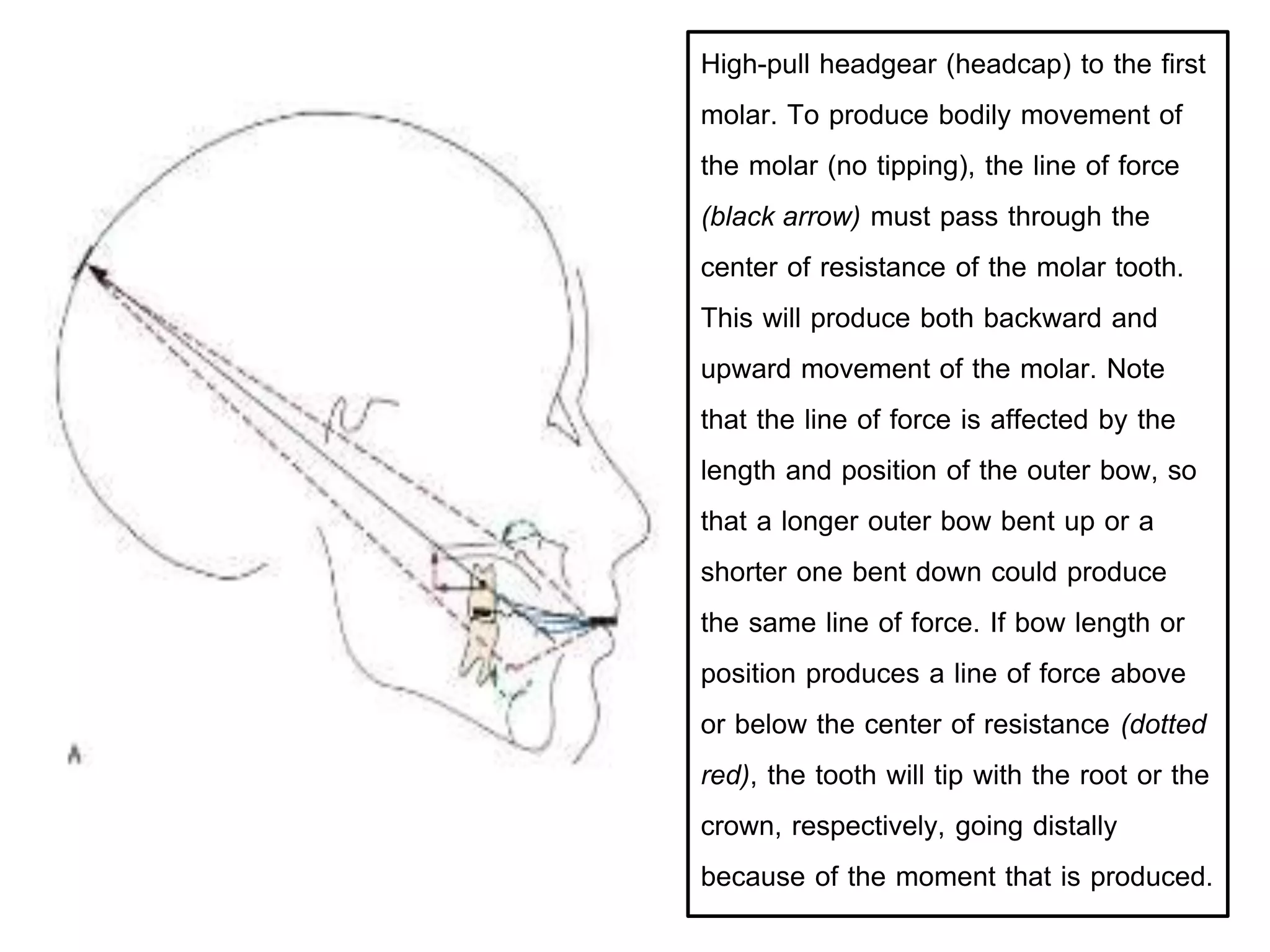 Biomechanics of Headgears | PPTX