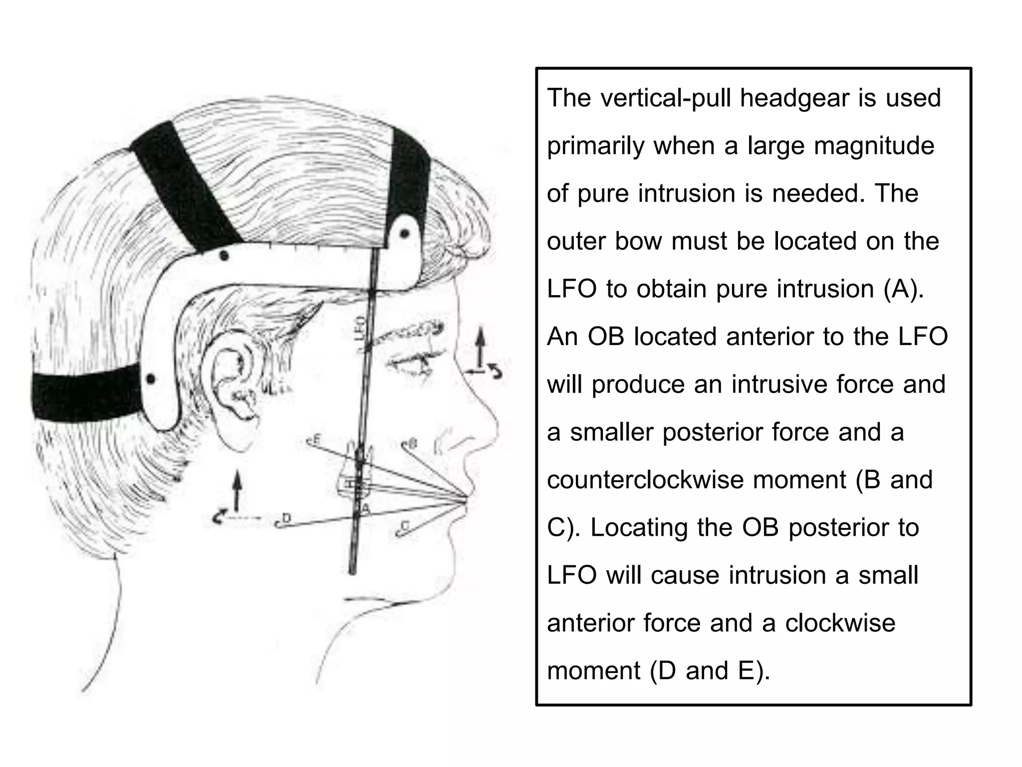 Biomechanics of Headgears | PPTX