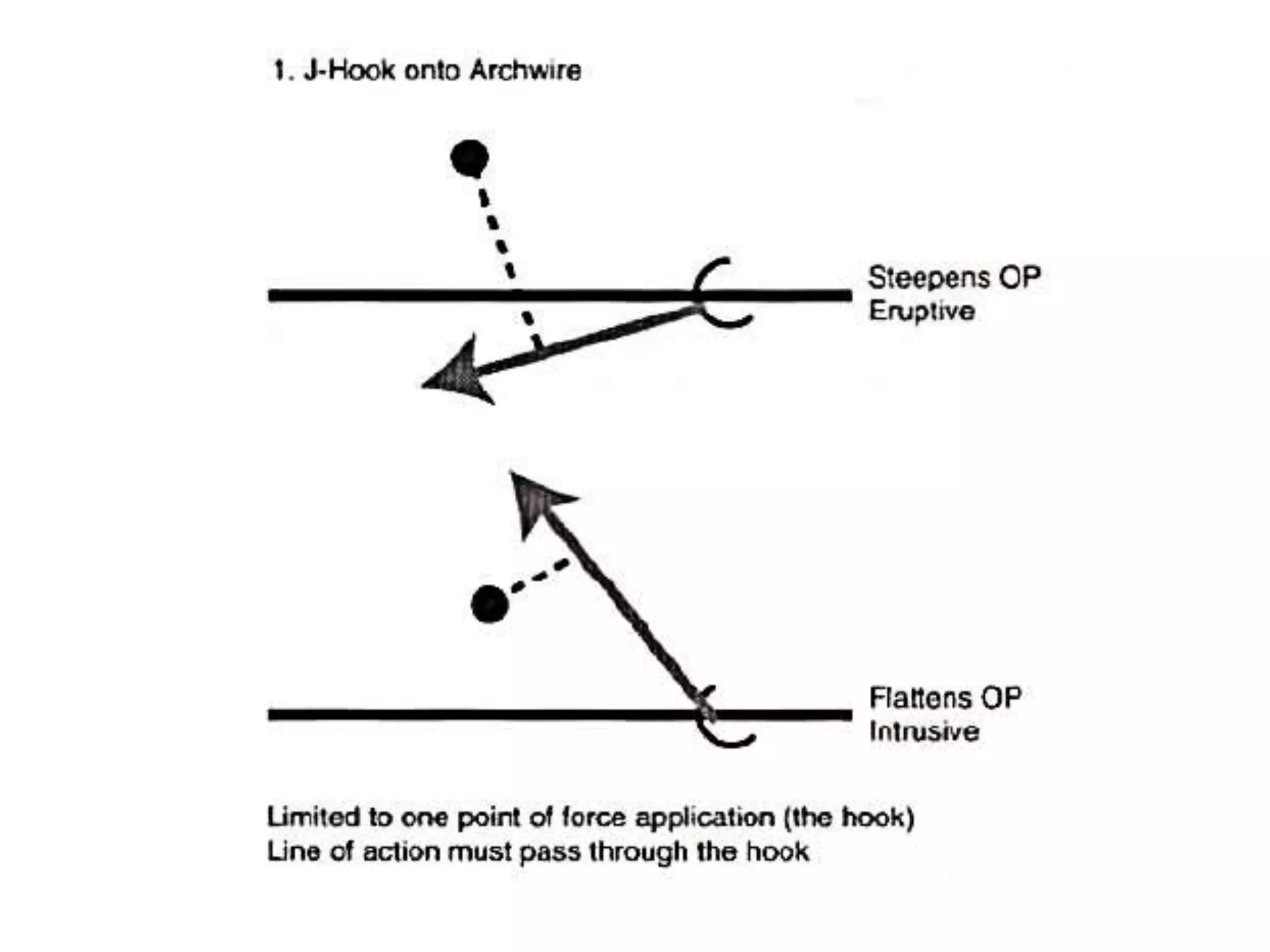 Biomechanics of Headgears | PPTX