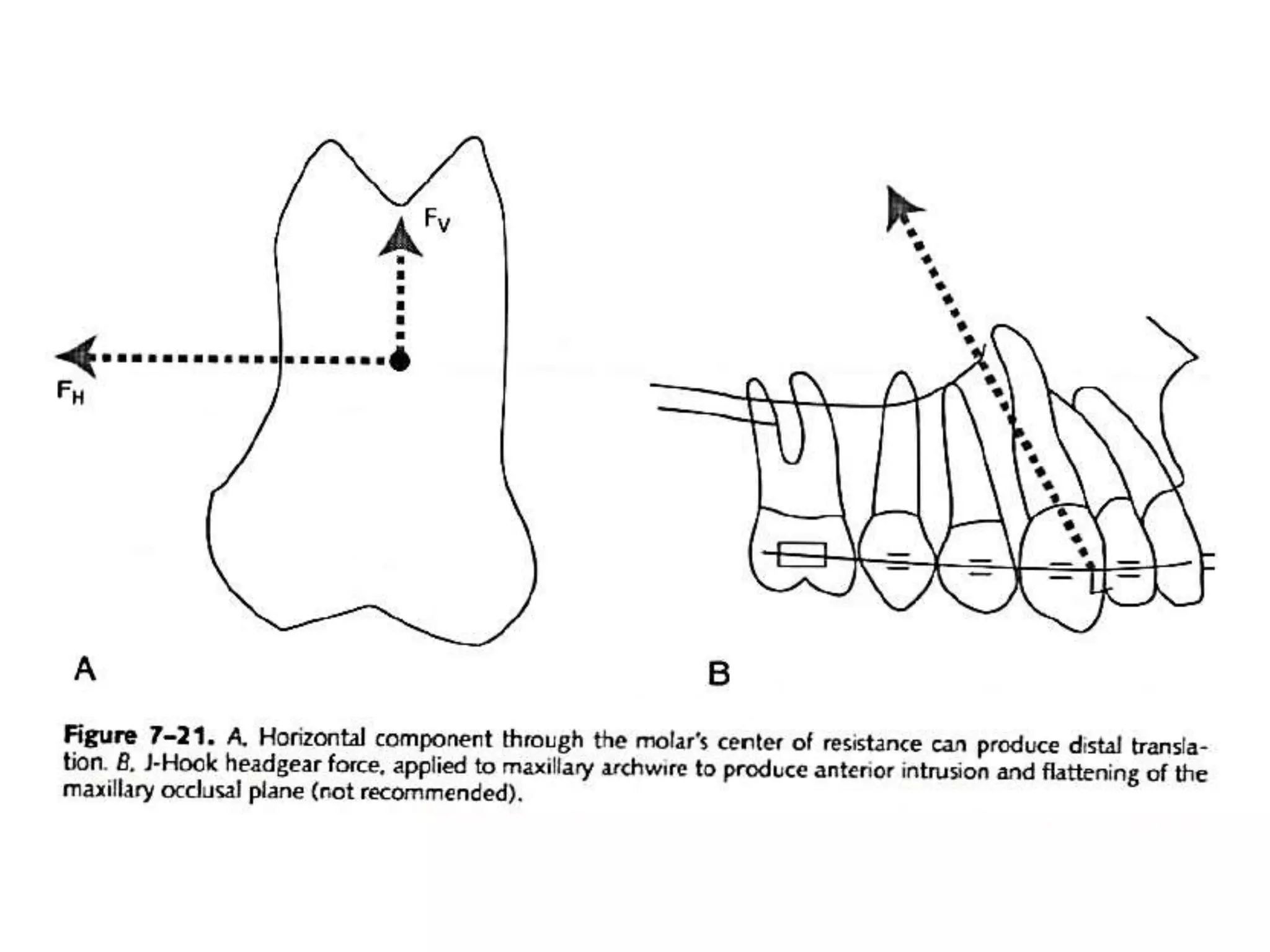 Biomechanics of Headgears | PPTX