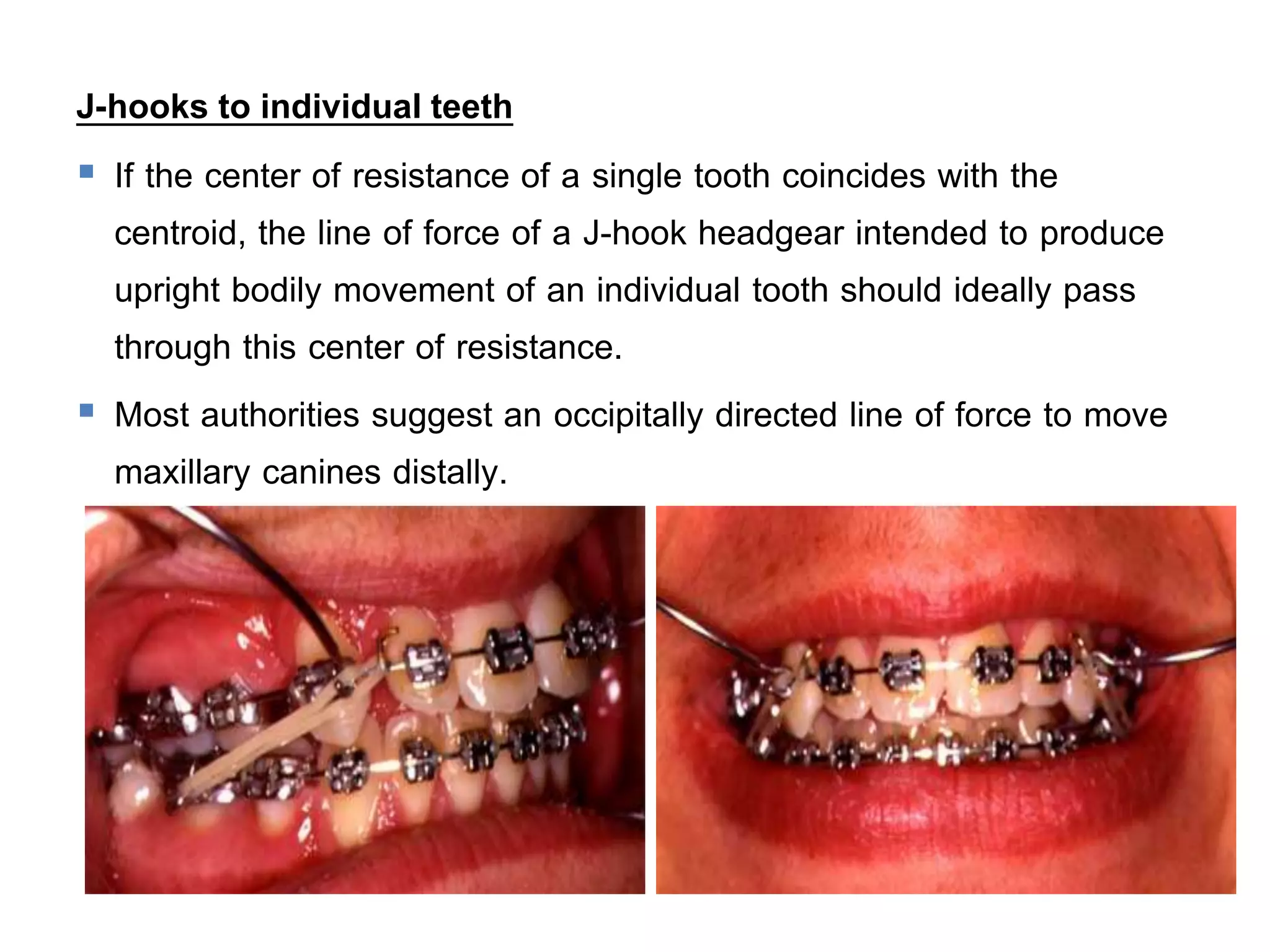 Biomechanics of Headgears | PPTX