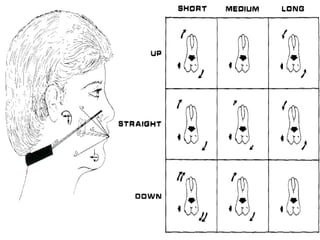 Biomechanics of Headgears | PPTX