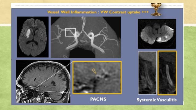 CNS vasculitis | PPTX | Brain and Nervous System Disorders | Diseases ...