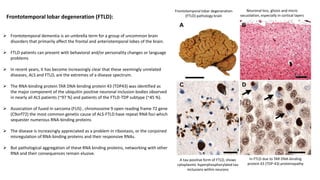 Discussion on ALS and FTD | PPTX