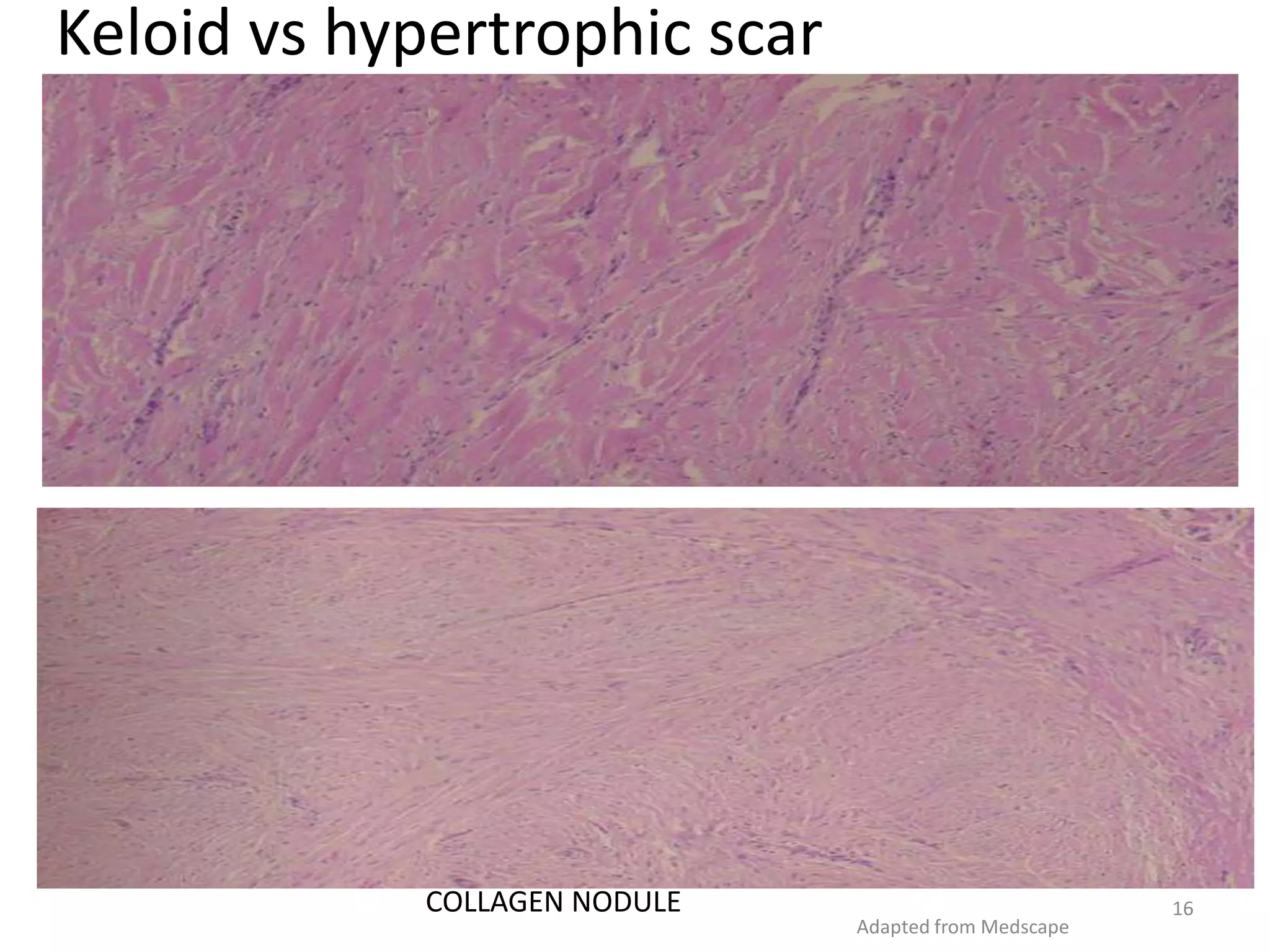Discuss keloid and hypertrophic scars | PDF