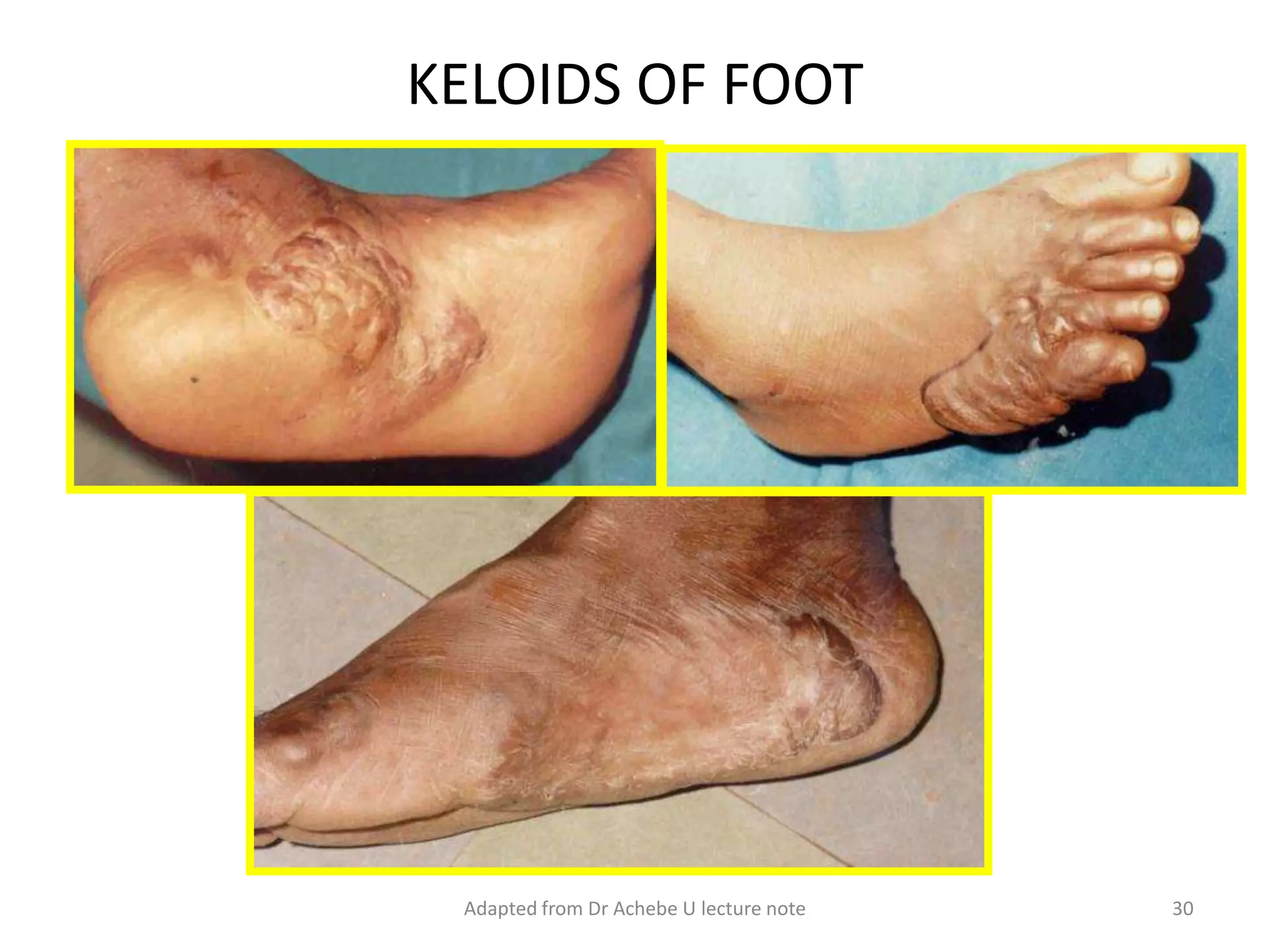 Discuss keloid and hypertrophic scars | PDF