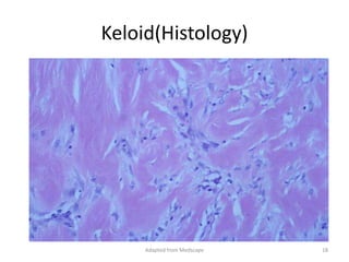 Keloid Histology