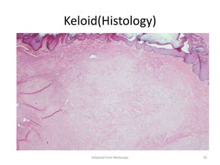 Keloid Histology