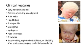 Comprehensive Overview of Oculocutaneous Albinism: Genetics, Clinical ...
