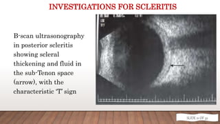DISCUSS THE COMPLICATIONS OF SCLERITIS.pptx