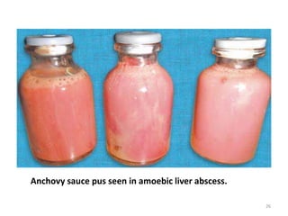 Anchovy Sauce Liver Abscess