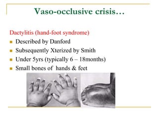 Sickle Cell Anemia Hand Foot Syndrome