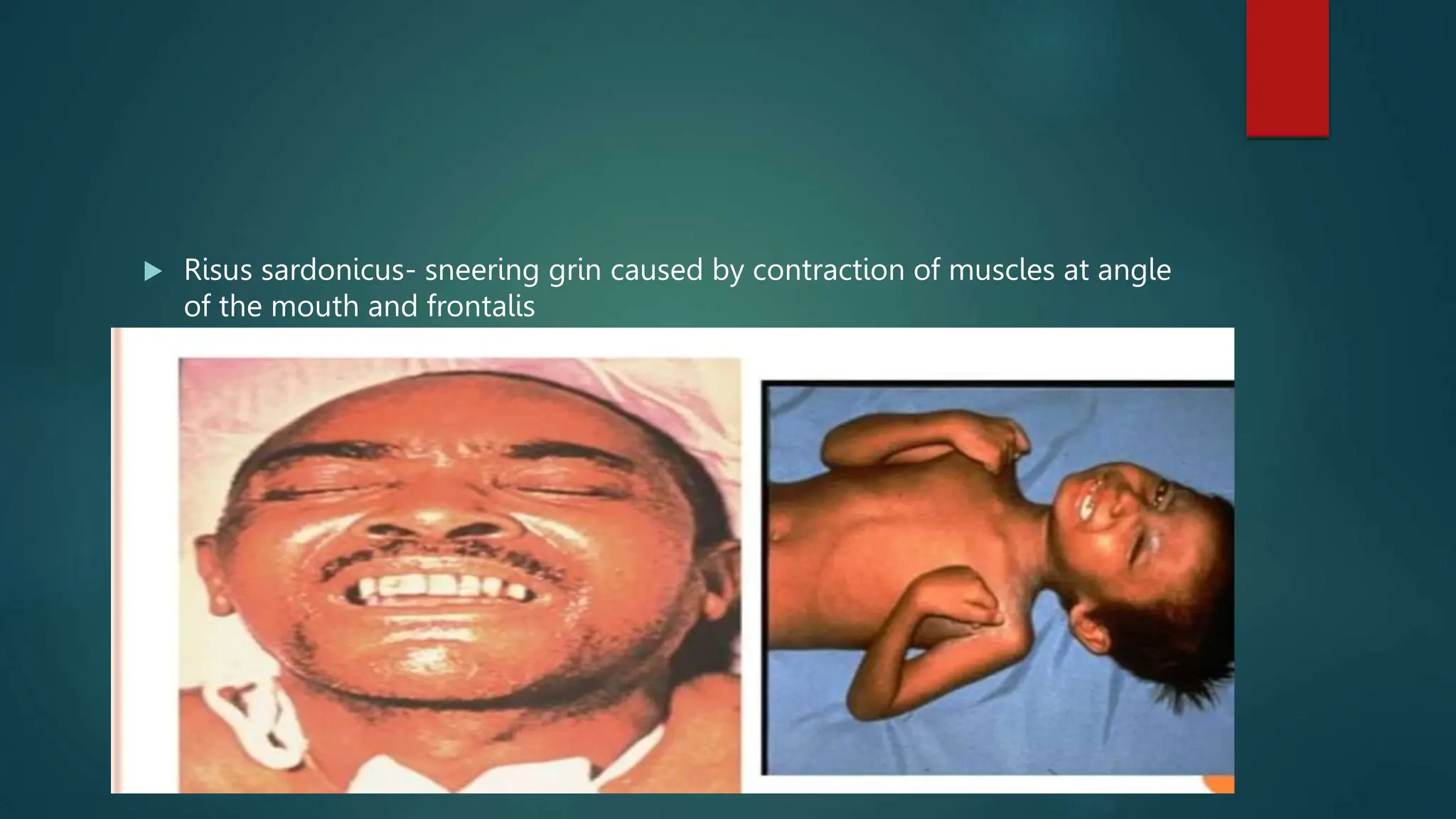 DISCUSS THE PATHOGENESIS,CLINICAL PRESENTATION OF TETANUS.ADD A NOTE ON ...