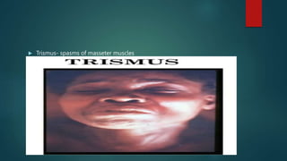 DISCUSS THE PATHOGENESIS,CLINICAL PRESENTATION OF TETANUS.ADD A NOTE ON ...