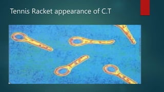 DISCUSS THE PATHOGENESIS,CLINICAL PRESENTATION OF TETANUS.ADD A NOTE ON ...