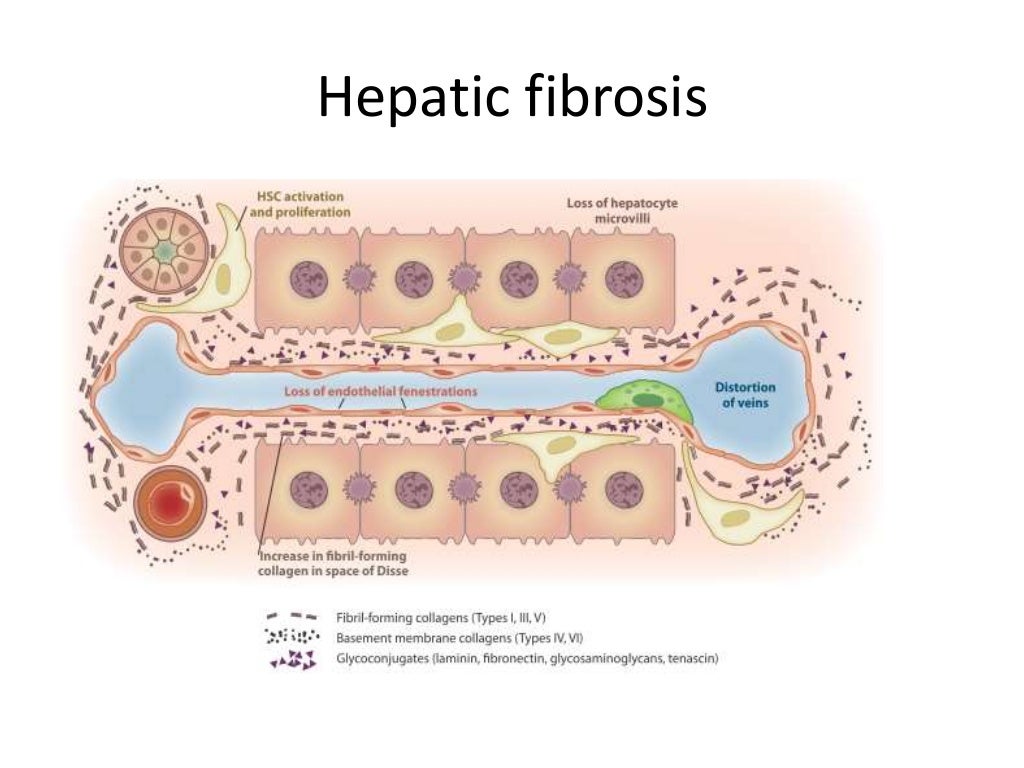 The pathogenesis of liver cirrhosis and fibrosis