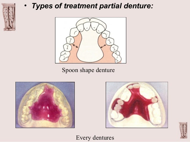 Discuss the role of rx partial denture/ dental implant courses
