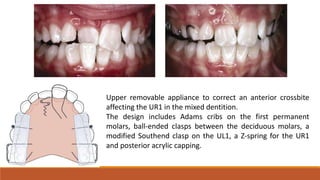 Applications of removable appliances in contemporary orthodontics | PPTX