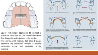 Applications of removable appliances in contemporary orthodontics | PPTX