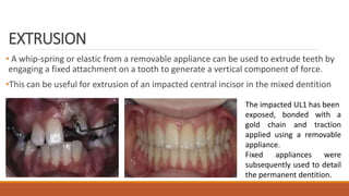 Applications of removable appliances in contemporary orthodontics | PPTX