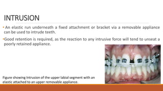Applications of removable appliances in contemporary orthodontics | PPTX