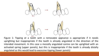Applications of removable appliances in contemporary orthodontics | PPTX