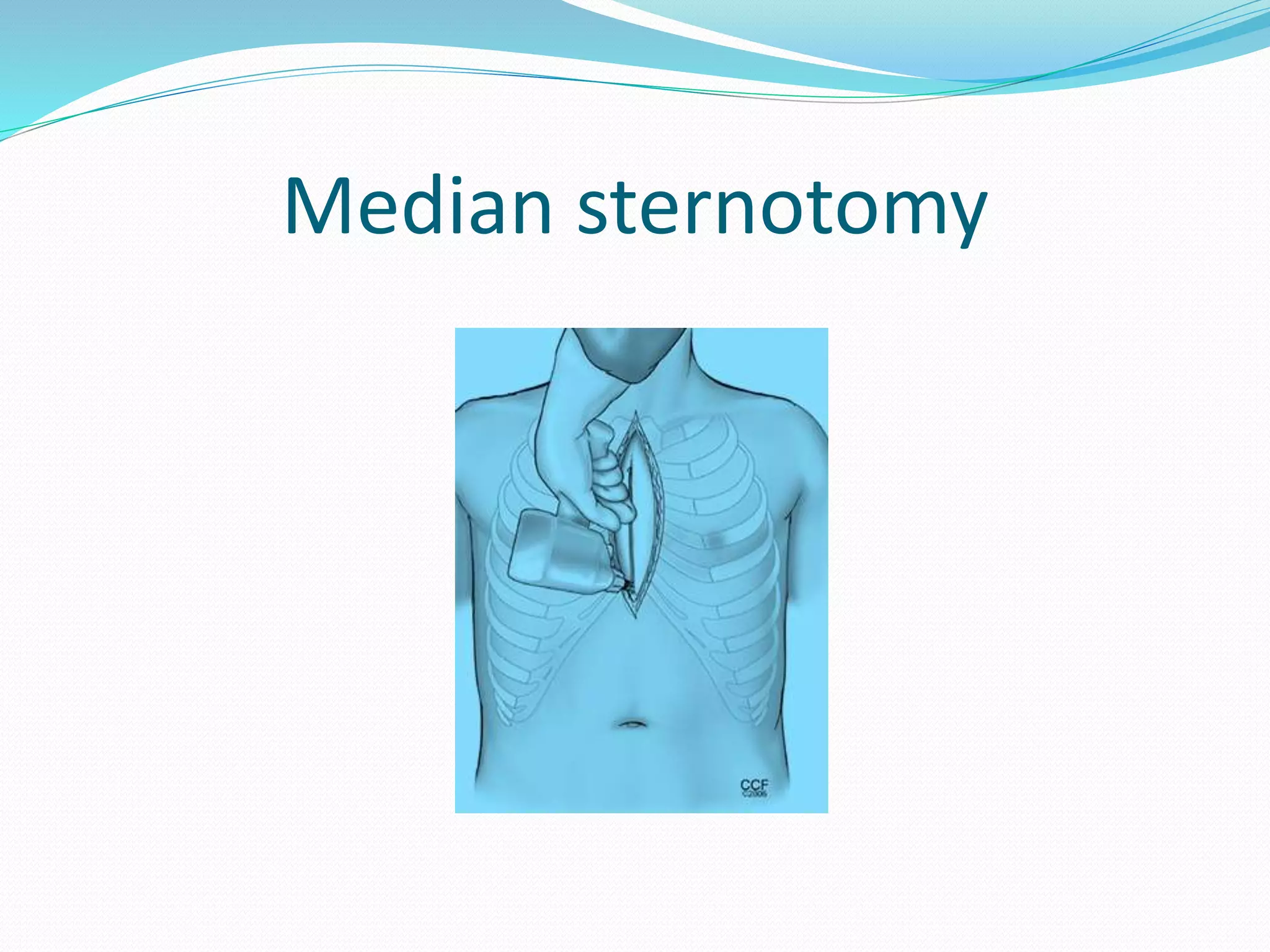 Discuss thoracic incisions(1) copy | PPTX