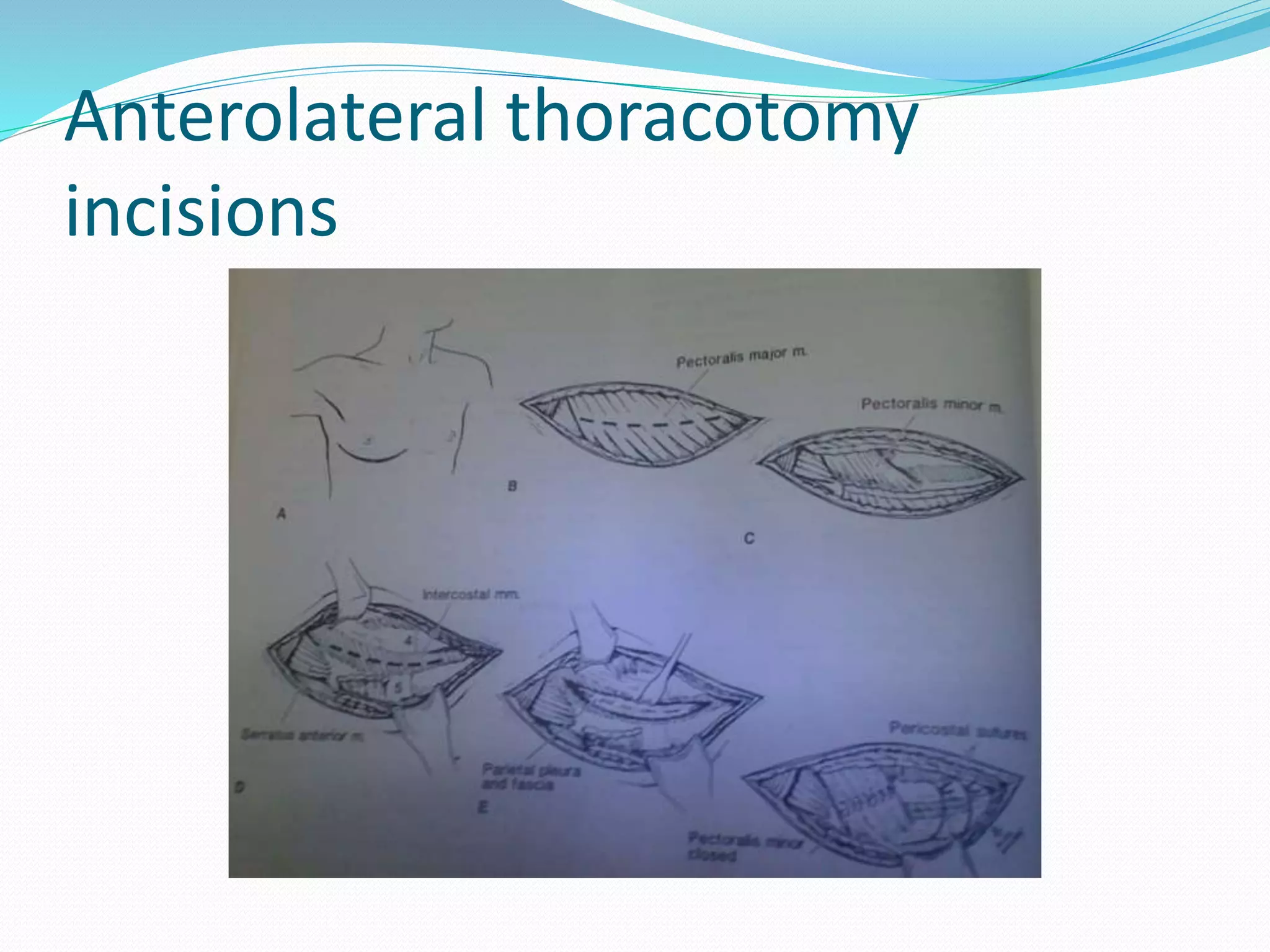 Discuss thoracic incisions(1) copy | PPTX
