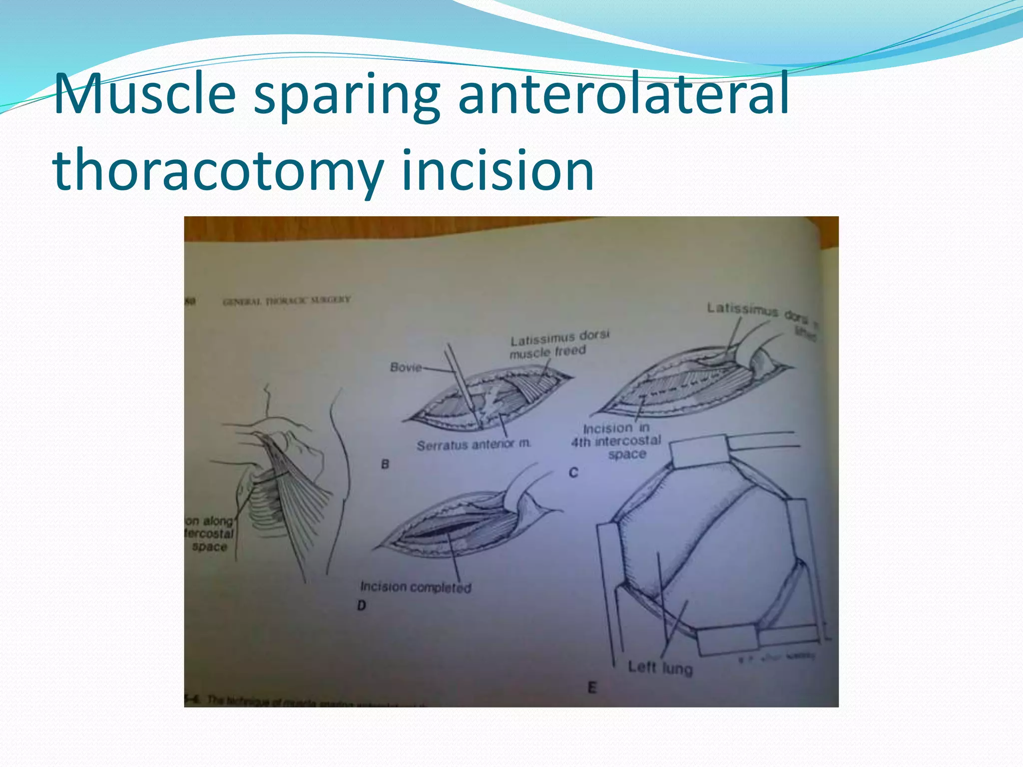 Discuss thoracic incisions(1) copy | PPTX