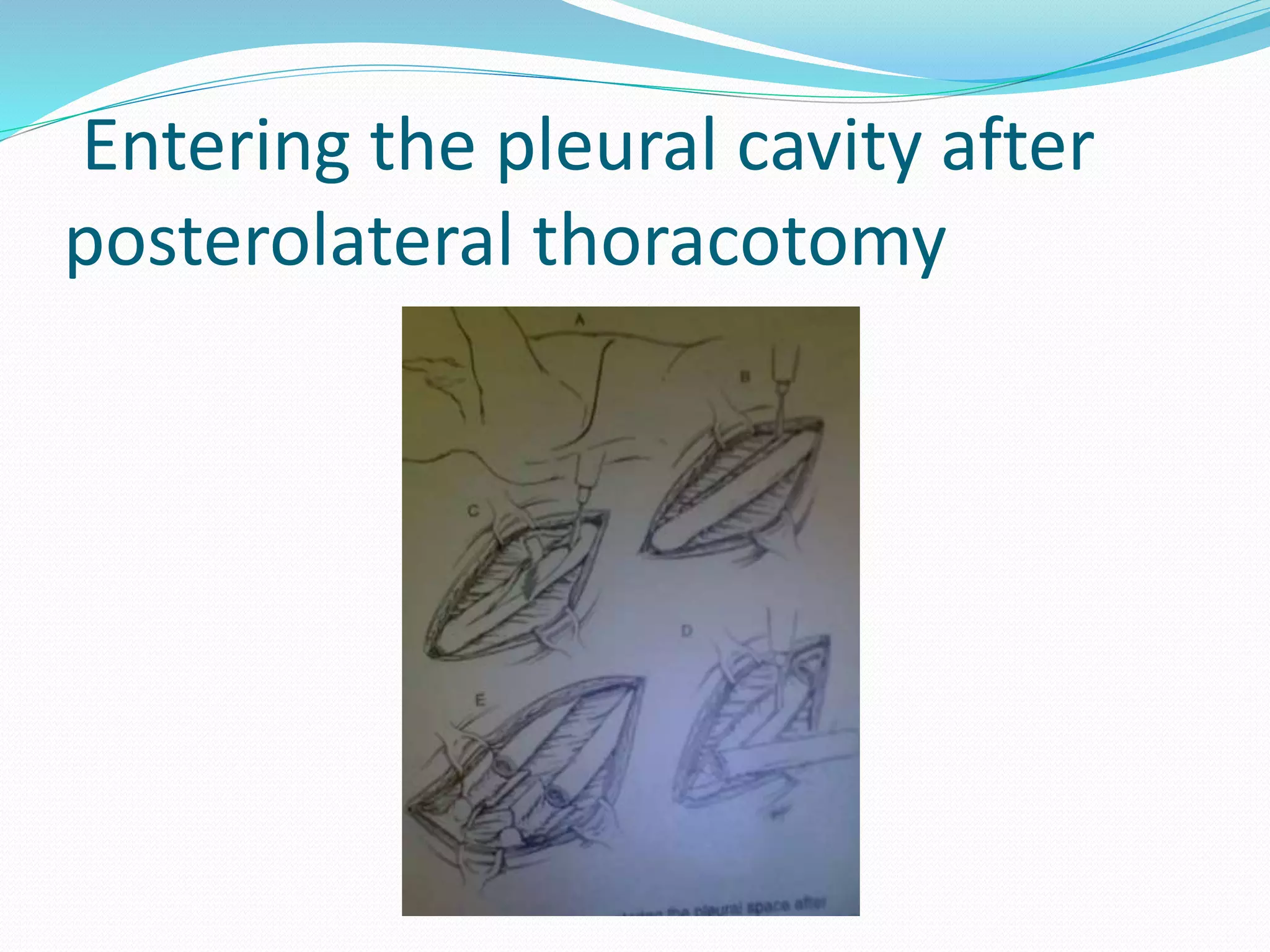 Discuss thoracic incisions(1) copy | PPTX