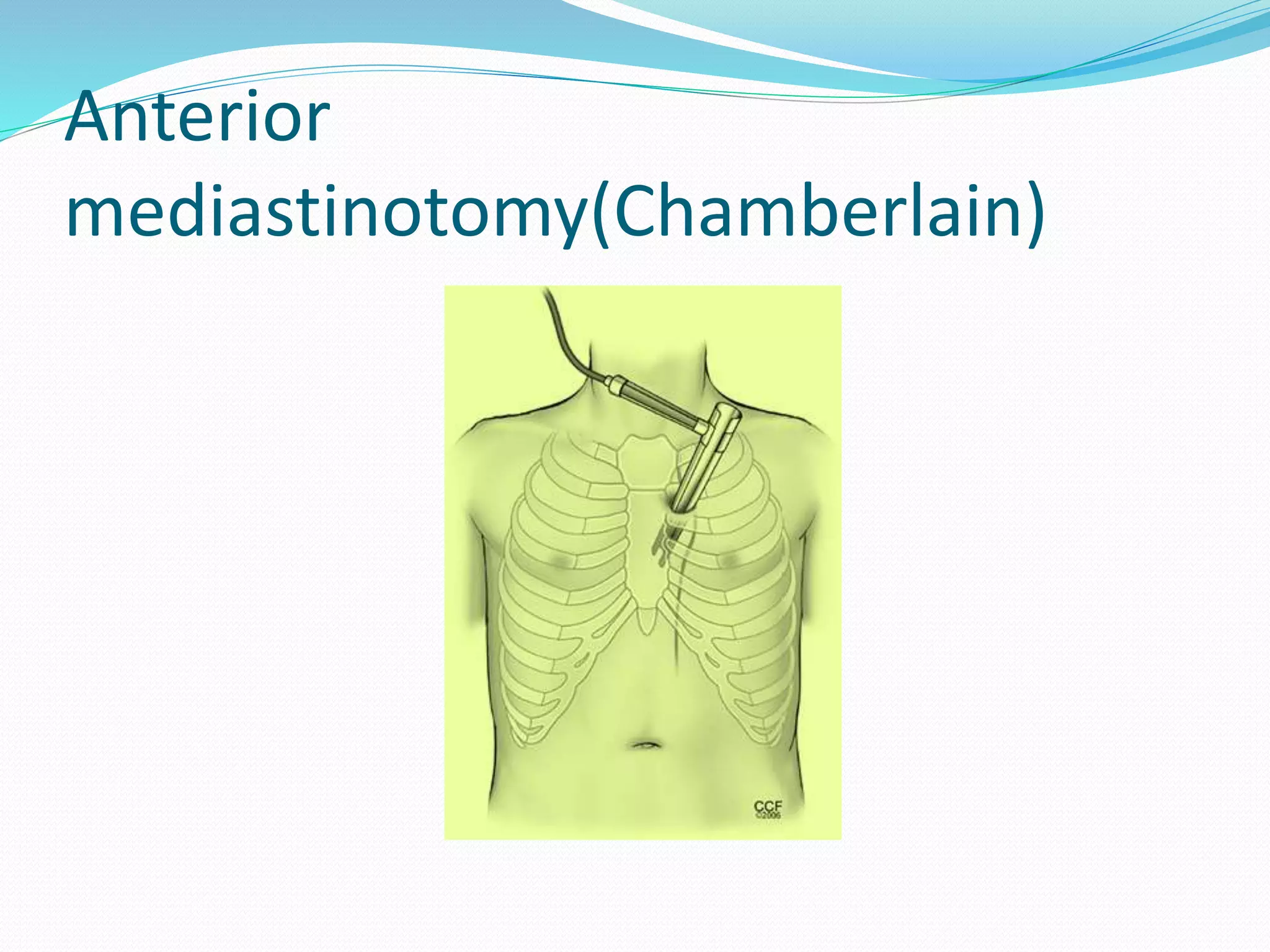 Discuss thoracic incisions(1) copy | PPTX