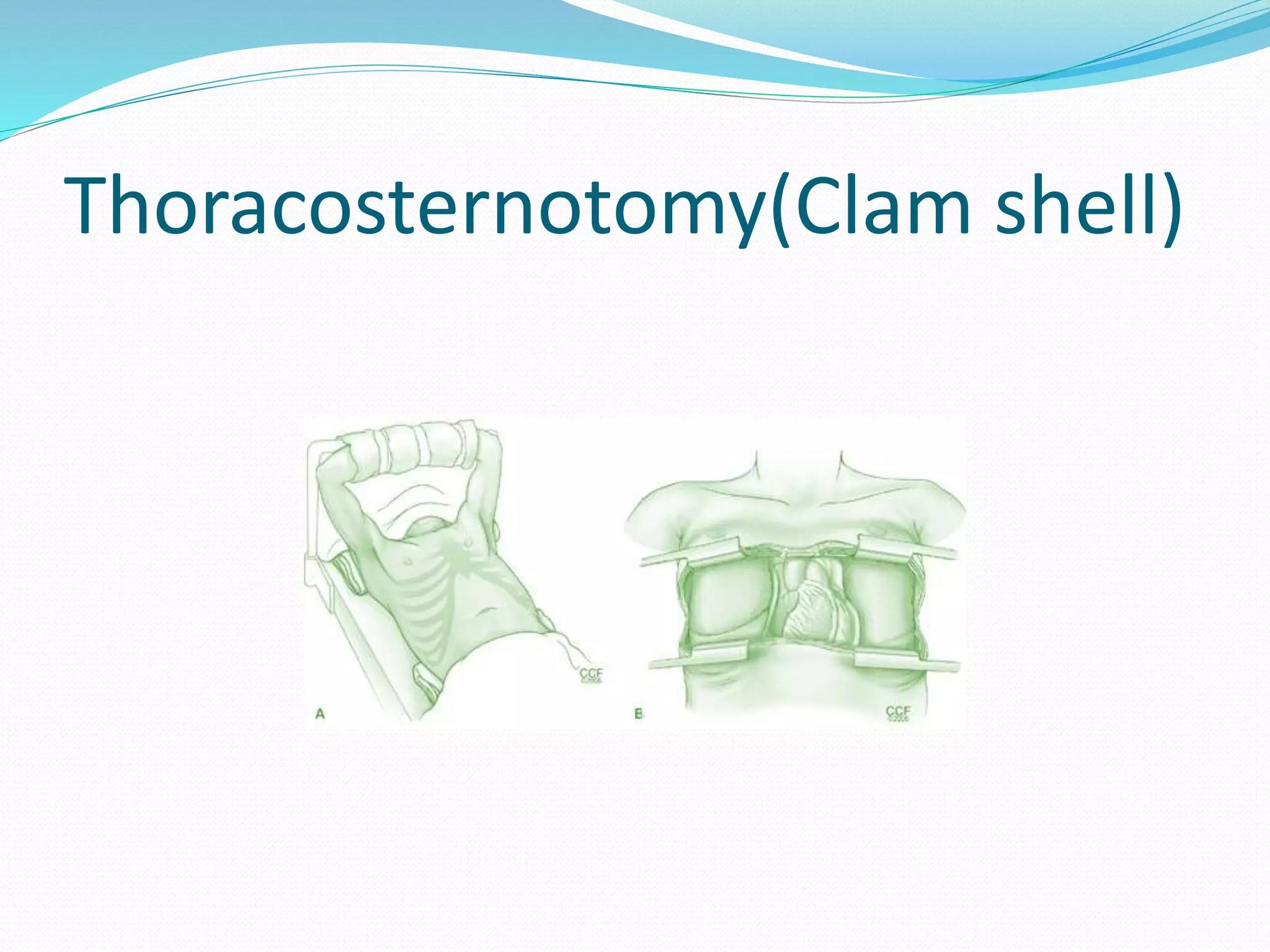 Discuss thoracic incisions(1) copy | PPTX