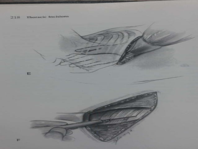 Discuss thoracic incisions(1) copy | PPTX