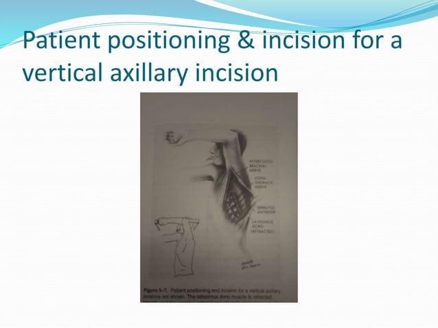Discuss thoracic incisions(1) copy | PPTX