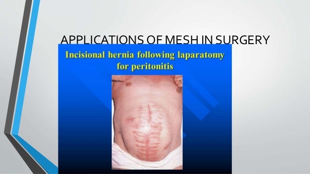 Discuss use of mesh in surgery