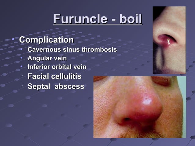 Diseases of external nose | PPT
