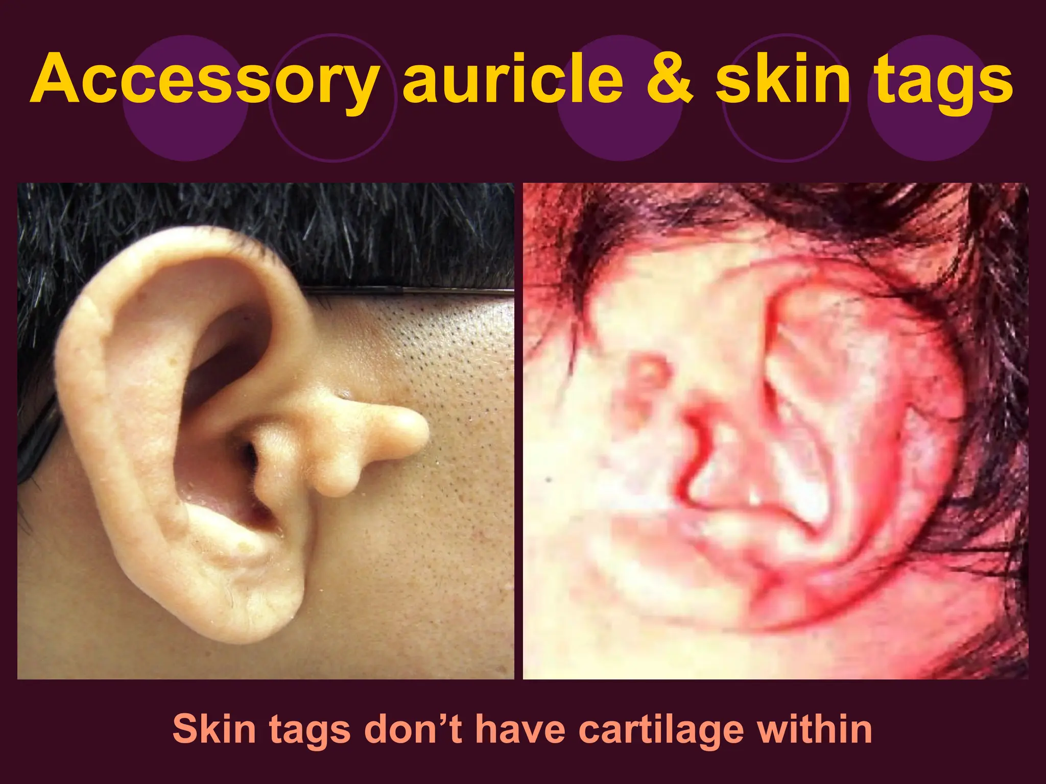 diseaes of external ear undergraduate ppt | PPT