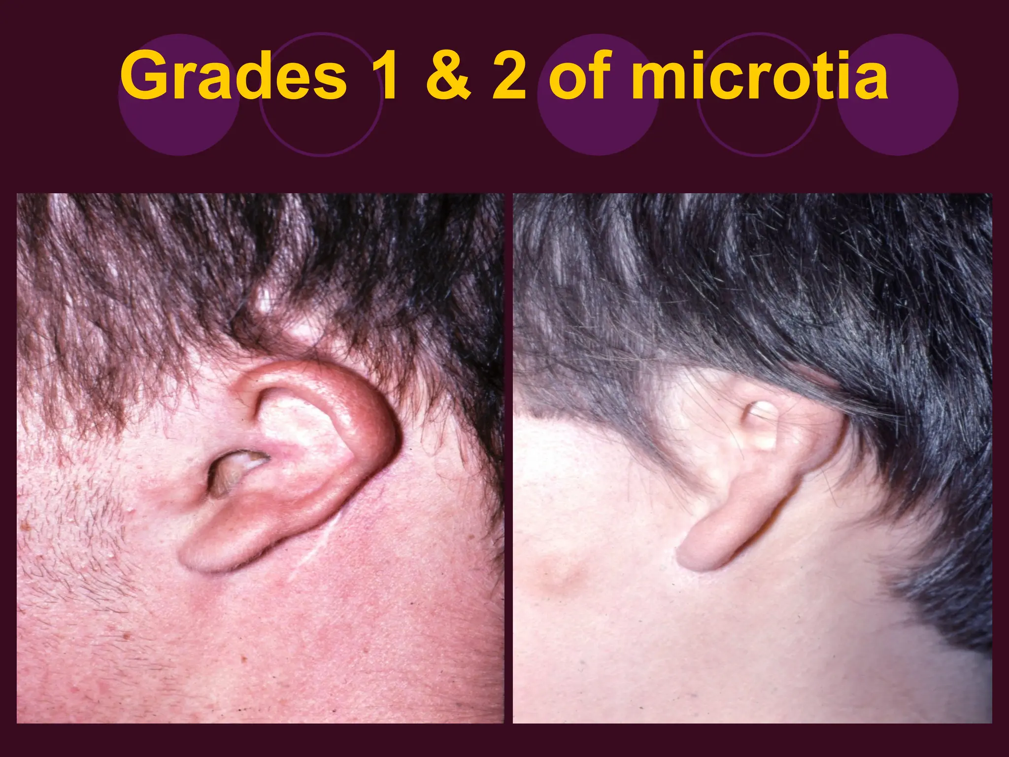 diseaes of external ear undergraduate ppt | PPT