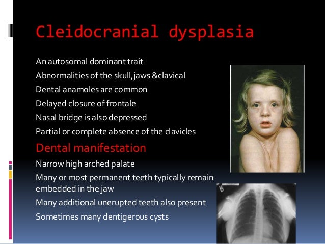 Cleidocranial Dysplasia Intraoral