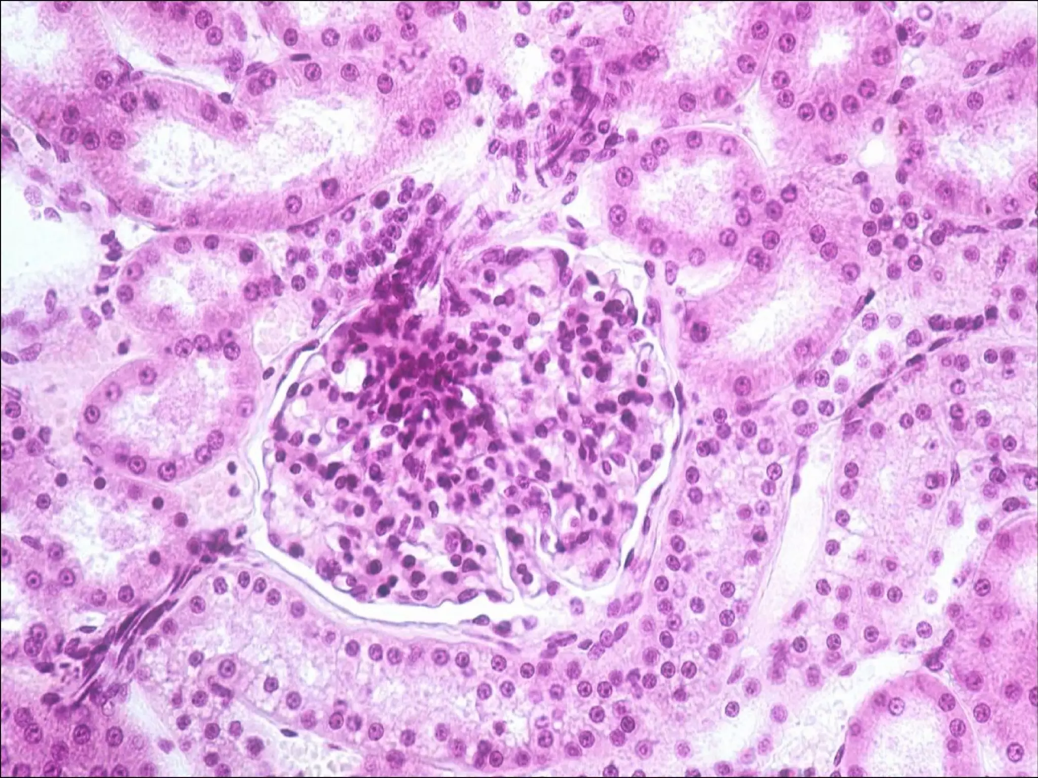 Disease affecting tubules and interstitium | PPT