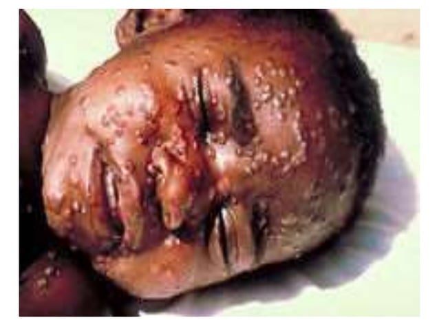 disease eradication.pptx | Free Download