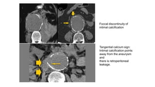 Radiological approach to aortic aneurysm and acute diseases | PPTX