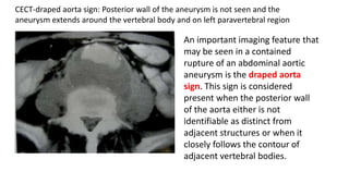 Radiological approach to aortic aneurysm and acute diseases | PPTX
