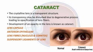 DISEASE OF CRYSTALLINE LENS, CATARACTpptx | PPTX